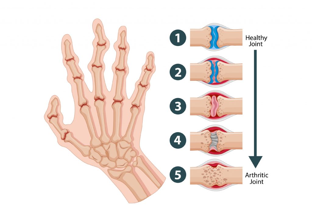 SLM | Understanding Arthritis